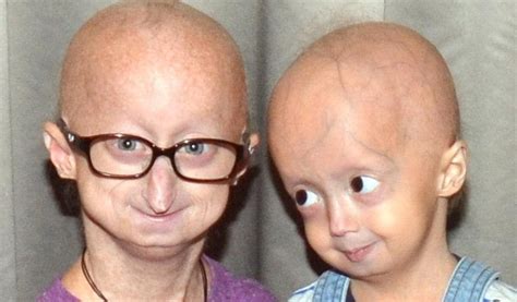 Sarah Mathieson On Linkedin Progeria Ema Raredisease