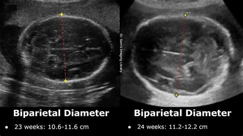 Fetal Biparietal Diameter Ultrasound Normal Values Bpd Measurements Biometric Parameters Usg Fetal Biparietal Diameter Ultrasound Normal Values Bpd Measurements Biometric Parameters Usg