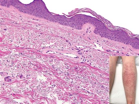 Progressive Telangiectatic Rash Mdedge