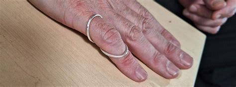 Swan Neck Deformity Managing It With Orthopedic Silver Ring Splints
