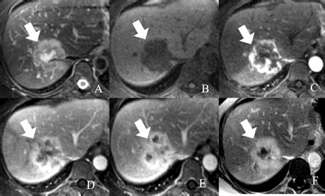 67 Year Old Female With Intrahepatic Cholangiocarcinoma A Axial T2wi Download Scientific