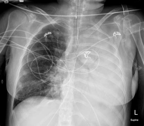 Rare Bulging Fissure Sign In Chest X Ray Cxr Of A Three 47 Off