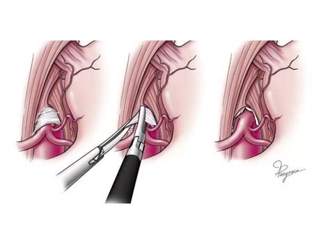 Management Of Mesenteric Vascular Occlusion Pptx Blood Disorders