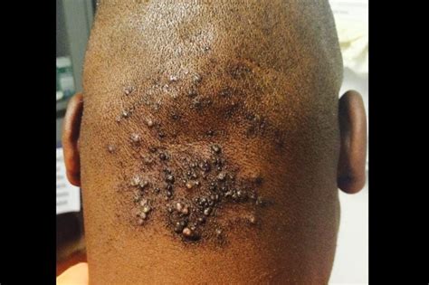Is A Scalp Infection Dangerous At George Bousquet Blog