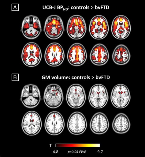 Synaptic Loss And Atrophy In Patients With Behavioral Variant Of