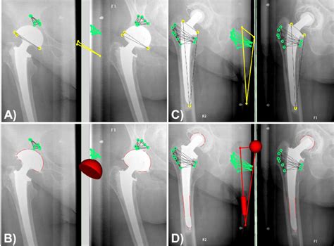 Four Examples Of Analyses A The Acetabular Cup Component With