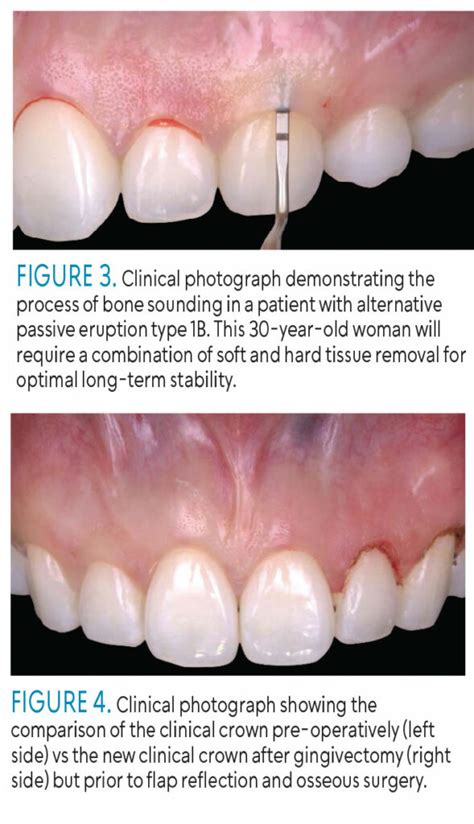 Understanding Altered Passive Eruption Dimensions Of Dental Hygiene