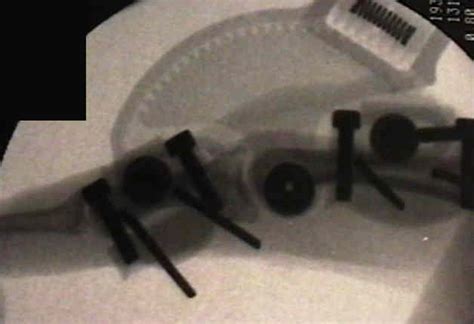 Volar PIP Dislocation Wheeless Textbook Of Orthopaedics