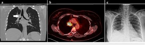 The Chest Ct Showing A Mass In The Right Upper Lobe Bronchus Extending Download Scientific