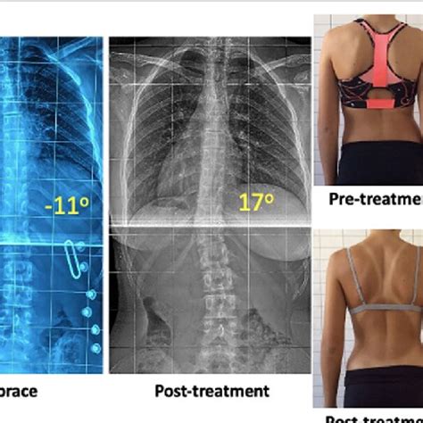 Ais Patient Treated With Brace And Psse Cobb Angle Was Improved From Download Scientific