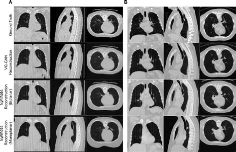 Transformers For Ct Reconstruction From Monoplanar And Biplanar