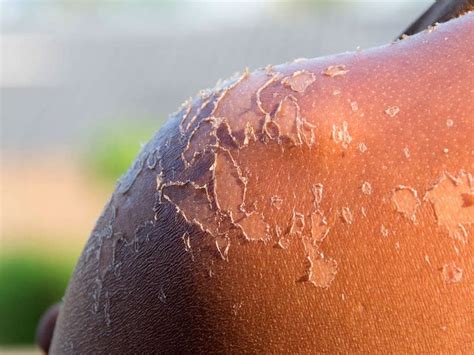 Vitiligo Symptoms Causes And Treatment