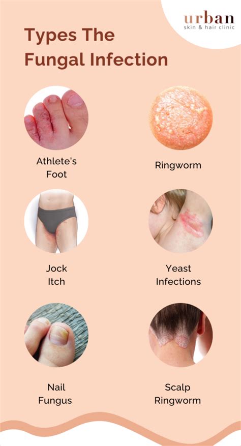 Fungal Infection Types Causes Symptoms And Treatment Ushc