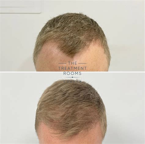 Mature Vs Receding Hairline Treatment Rooms London