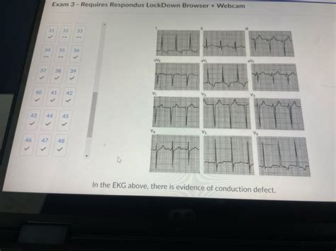 Is There Evidence Of Conduction Defect In The Ekg Shown Above Filo