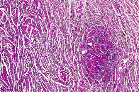 Human Cervical Ectropion Light Micrograph Stock Image C048 8565 Science Photo Library