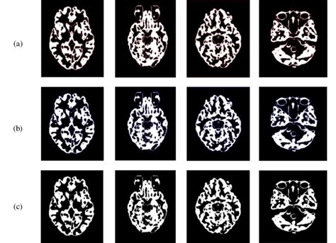 Brain Mri Segmentation Based On Level Set For Clustered Images By