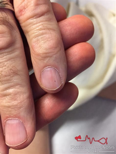 Splinter Hemorrhage Physical Diagnosis Pdx