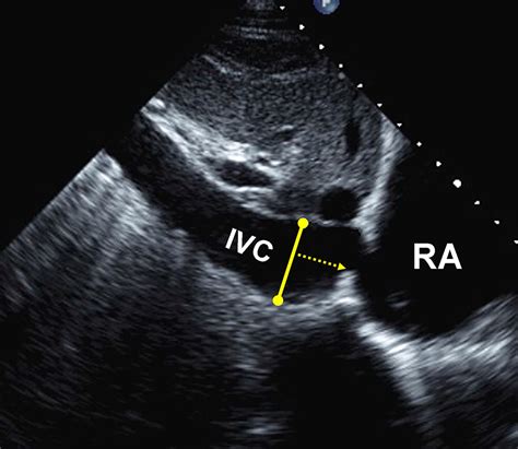 Guidelines For The Echocardiographic Assessment Of The Right Heart In