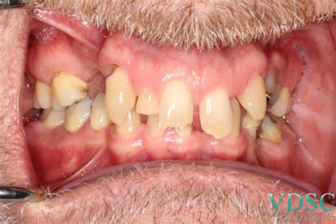 Vdschypodontiaorgeneticallymissingteeth2 Vdsc