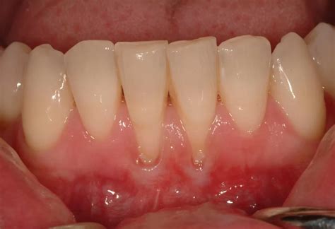 Sensitive Teeth Clinic Effect