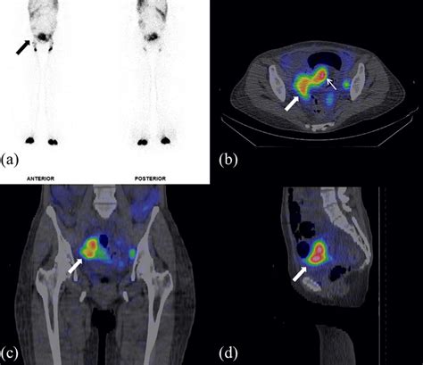 Planar Image Of Lymphoscintigraphy Amd Multiplanar Reconstruction Of Download Scientific