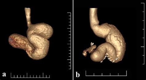 Ct Gastric Volumetry Of Two Cases Showing A Gt With Primary Dilation