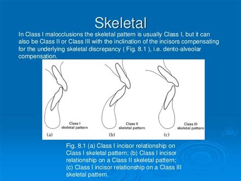 Class I Orthodontics Dentistry
