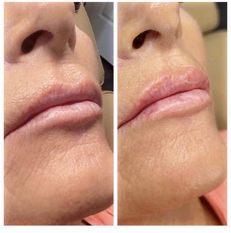 Lip Fillers Trends Of 2025 Third Eye Beauty Lounge Tempe Az