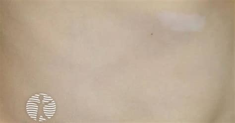 Ash Leaf Marks In Tuberous Sclerosis Image