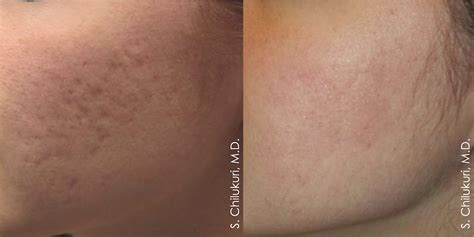 RF Microneedling 4 Refresh Dermatology