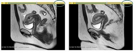Tag 00180050 Slice Thickness Does Not Correspond To What I Calculate In The Image Support