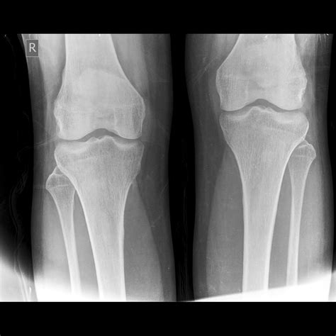 Knee X Ray Osteoporosis Database Kaggle