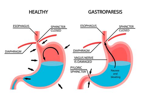 How Dangerous Is Gastroparesis Levin Papantonio