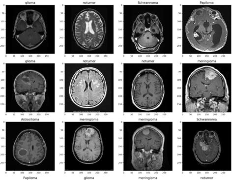 harsh maniya on linkedin deeplearning aiinhealthcare