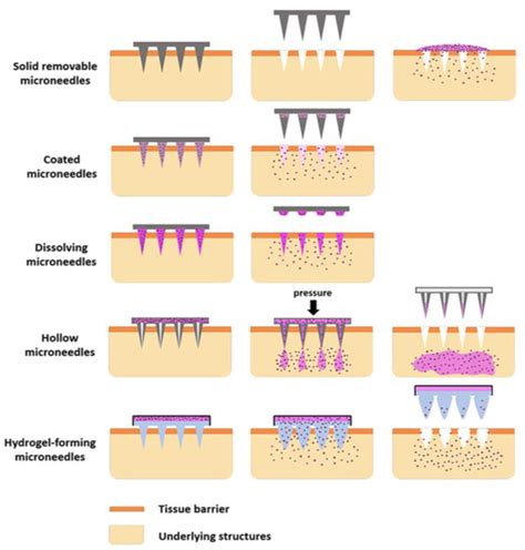 Polymeric Microneedles An Emerging Paradigm For Advanced Biomedical Applications
