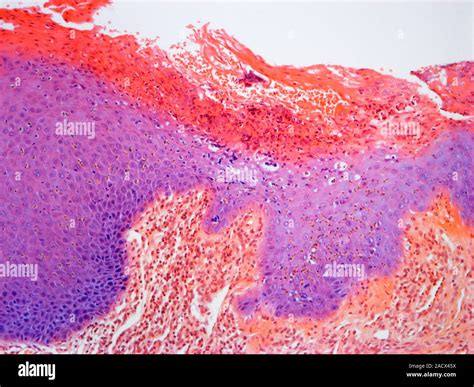 Section Of The Tongue With Thrush Light Micrograph Oral Thrush Is A