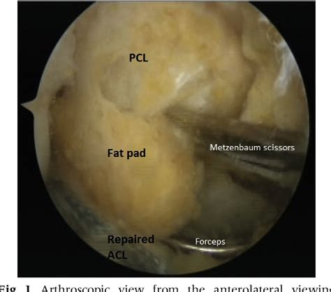 Figure 1 From Synovialization And Revascularization Enhancement In