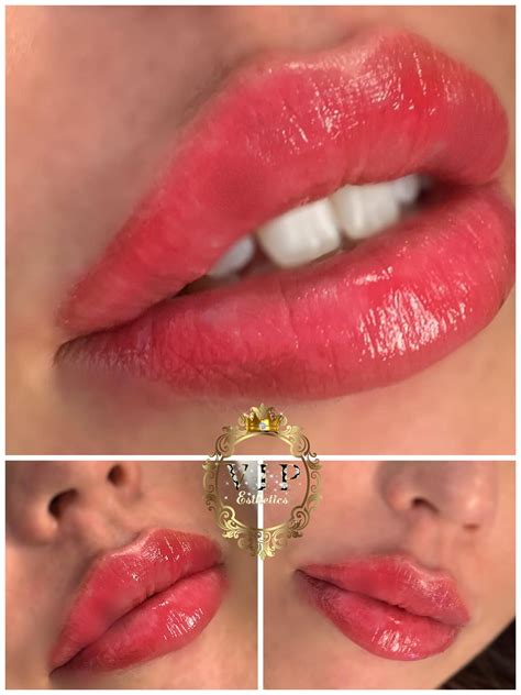 Lip Enhancement Gallery Junglinster Luxembourg Advance Aesthetics