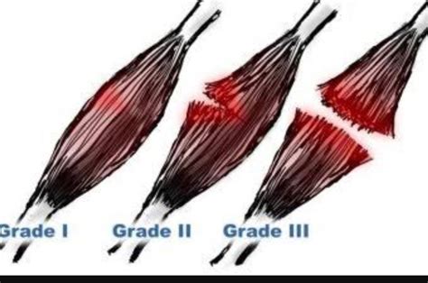 Third Grade Hamstring Tear ⋆ Santa Barbara Deep Tissue Riktr Pro Massage Nicola Lmt