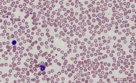 Haemoglobin E Learnhaem Haematology Made Simple