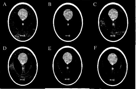 Figure 5 From Exact Spiral Scan Region Of Interest Cone Beam Ct Via Backprojection Semantic