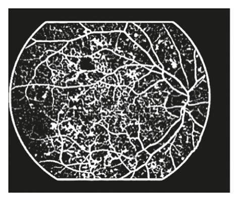seed points extraction a response of matched filter b