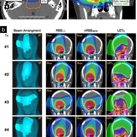 Pediatric Low Grade Glioma Case Study Treatment Planning Download Scientific Diagram