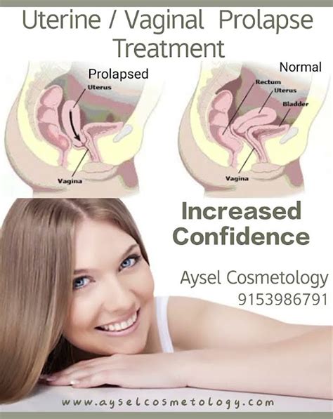 Vaginal Prolapse Treatment Youtube