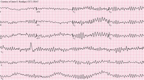 Ventricular Fibrillation Vs Atrial Fibrillation Ventricular