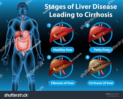 Stages Liver Disease Leading Cirrhosis Illustration Stock Vector