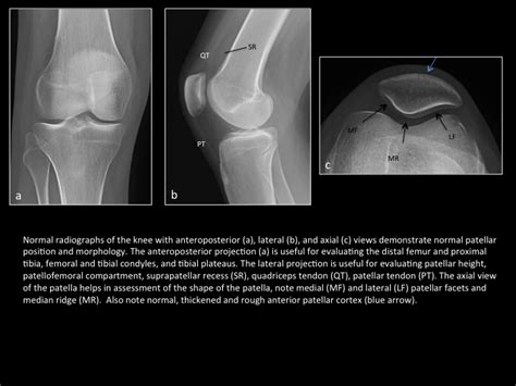 Patella X Ray Labeled