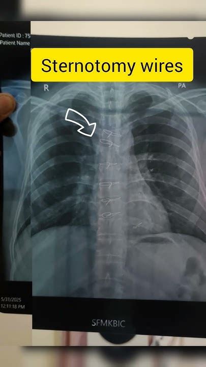 Sternotomy Wirescabg Youtubeshorts Ihd Cardiacrehab Heartdisease
