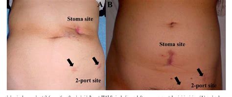 Stage Colon Cancer Surgery Cancerwalls